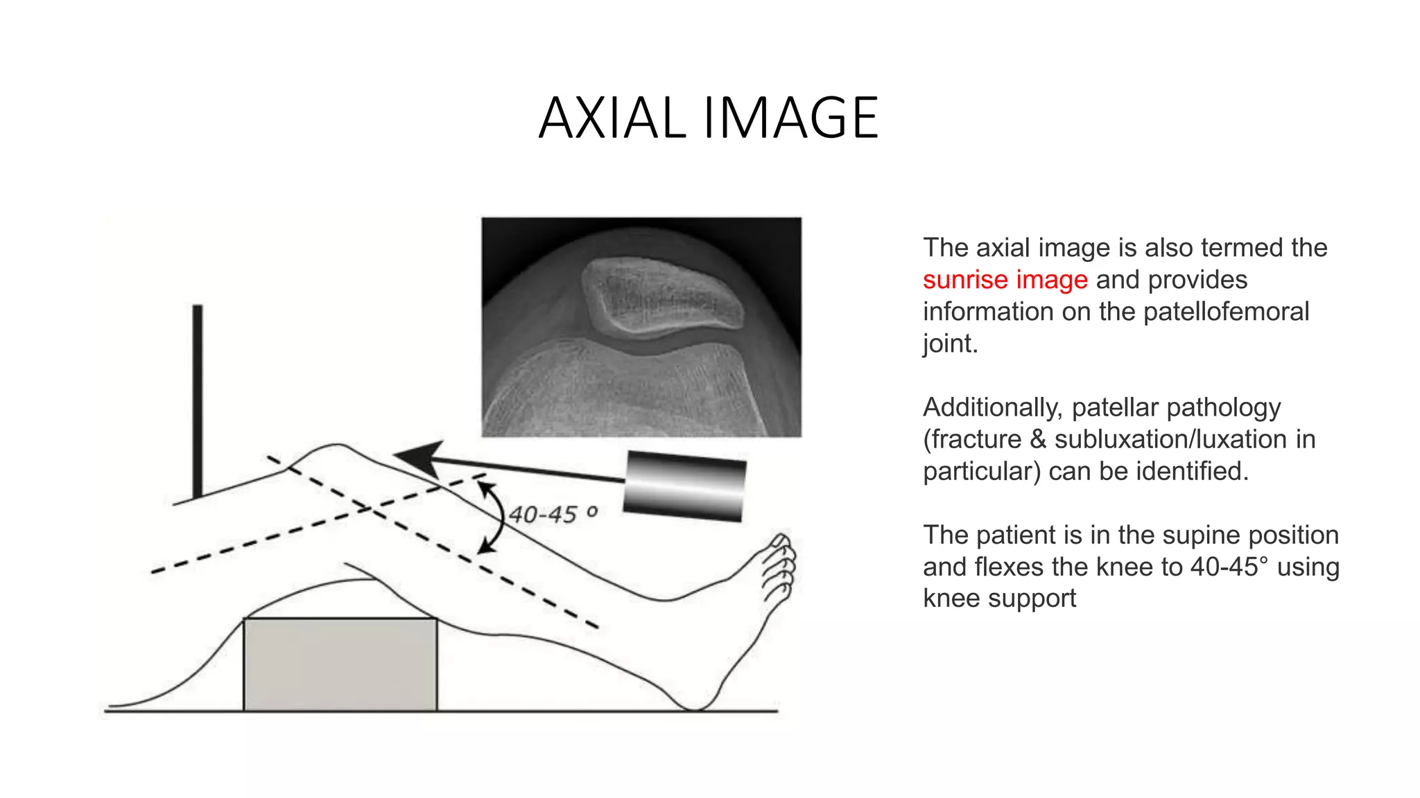X Ray and MRI of Knee Joint | PPTX