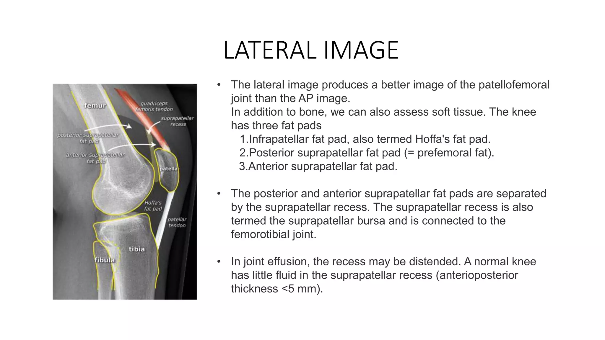 X Ray and MRI of Knee Joint | PPTX
