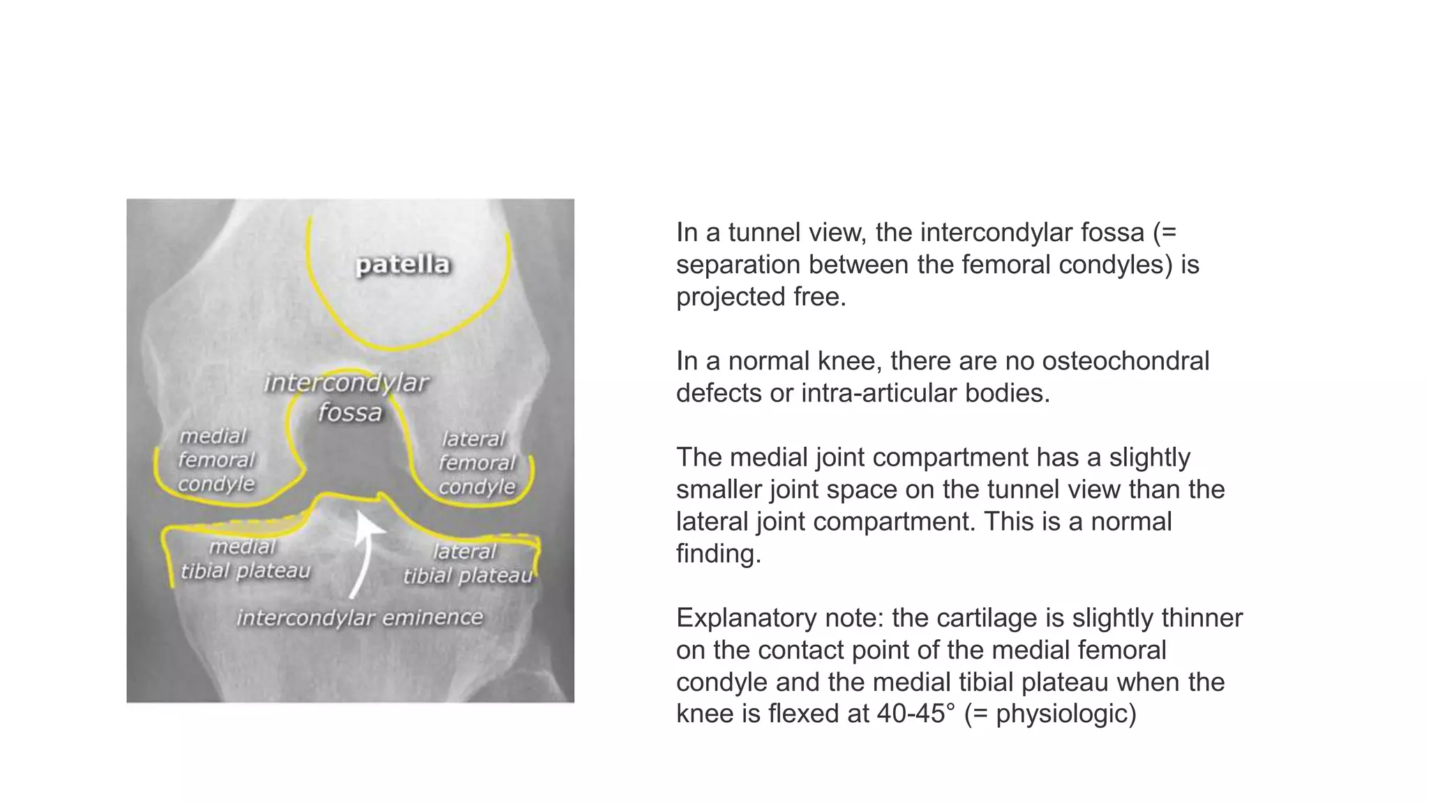 X Ray and MRI of Knee Joint | PPTX