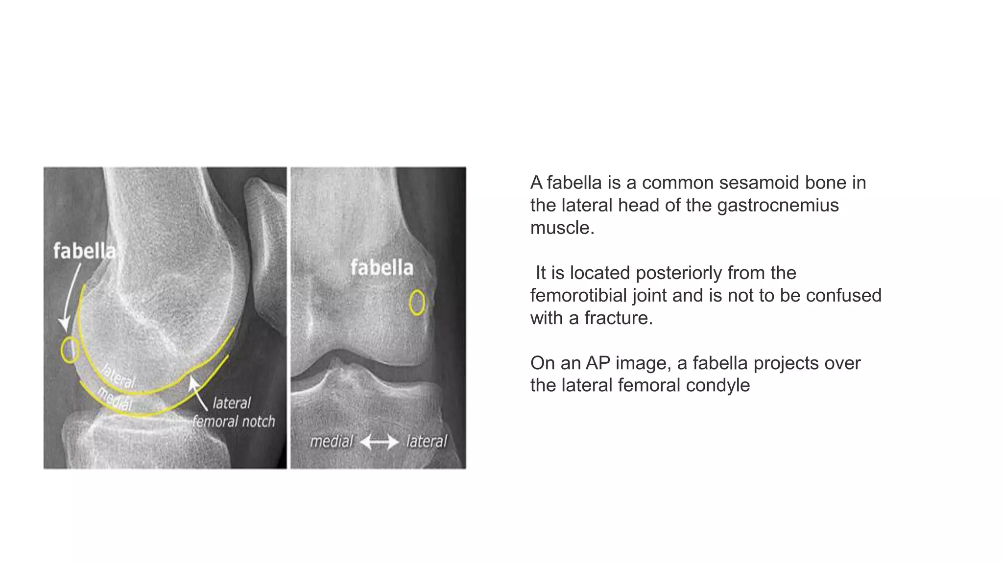 X Ray and MRI of Knee Joint | PPTX