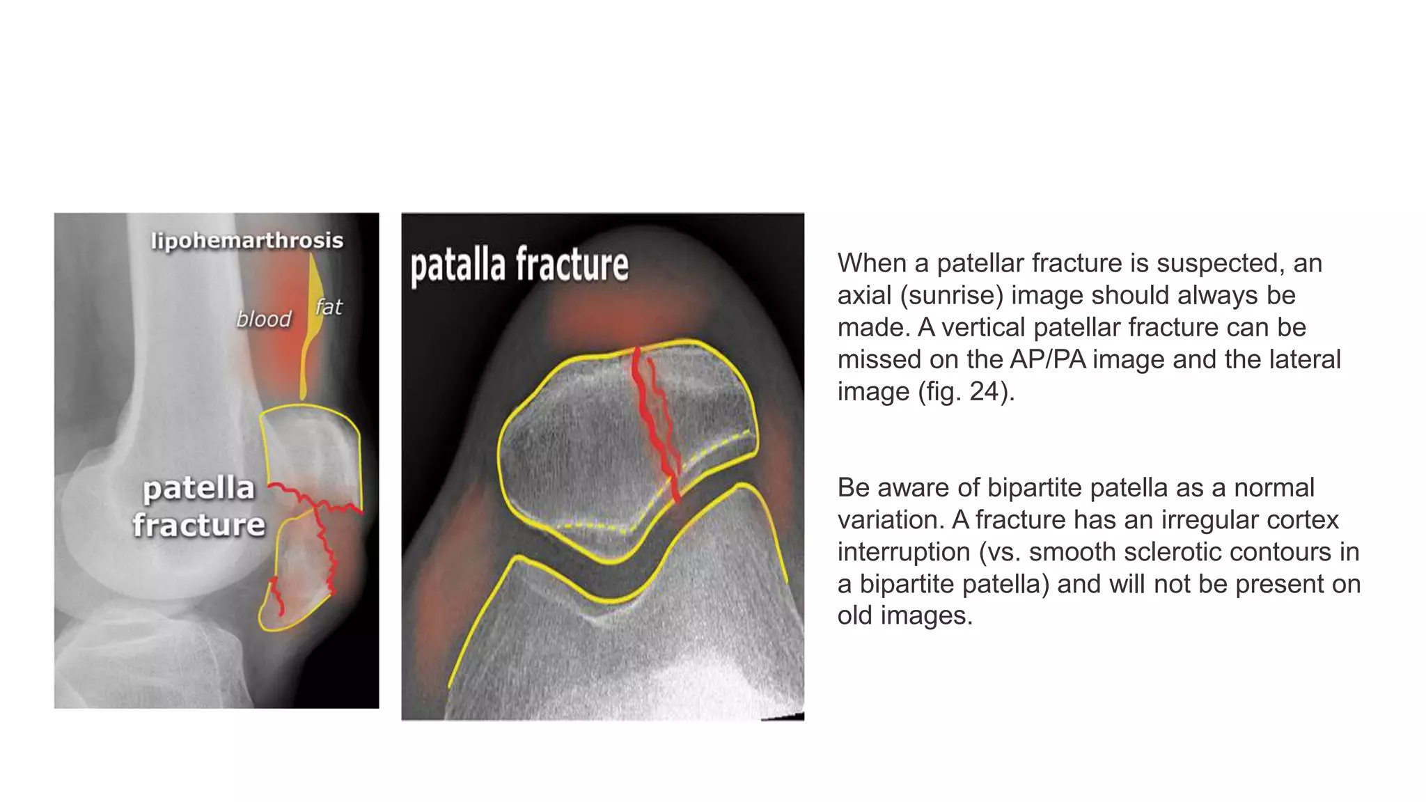 X Ray and MRI of Knee Joint | PPTX