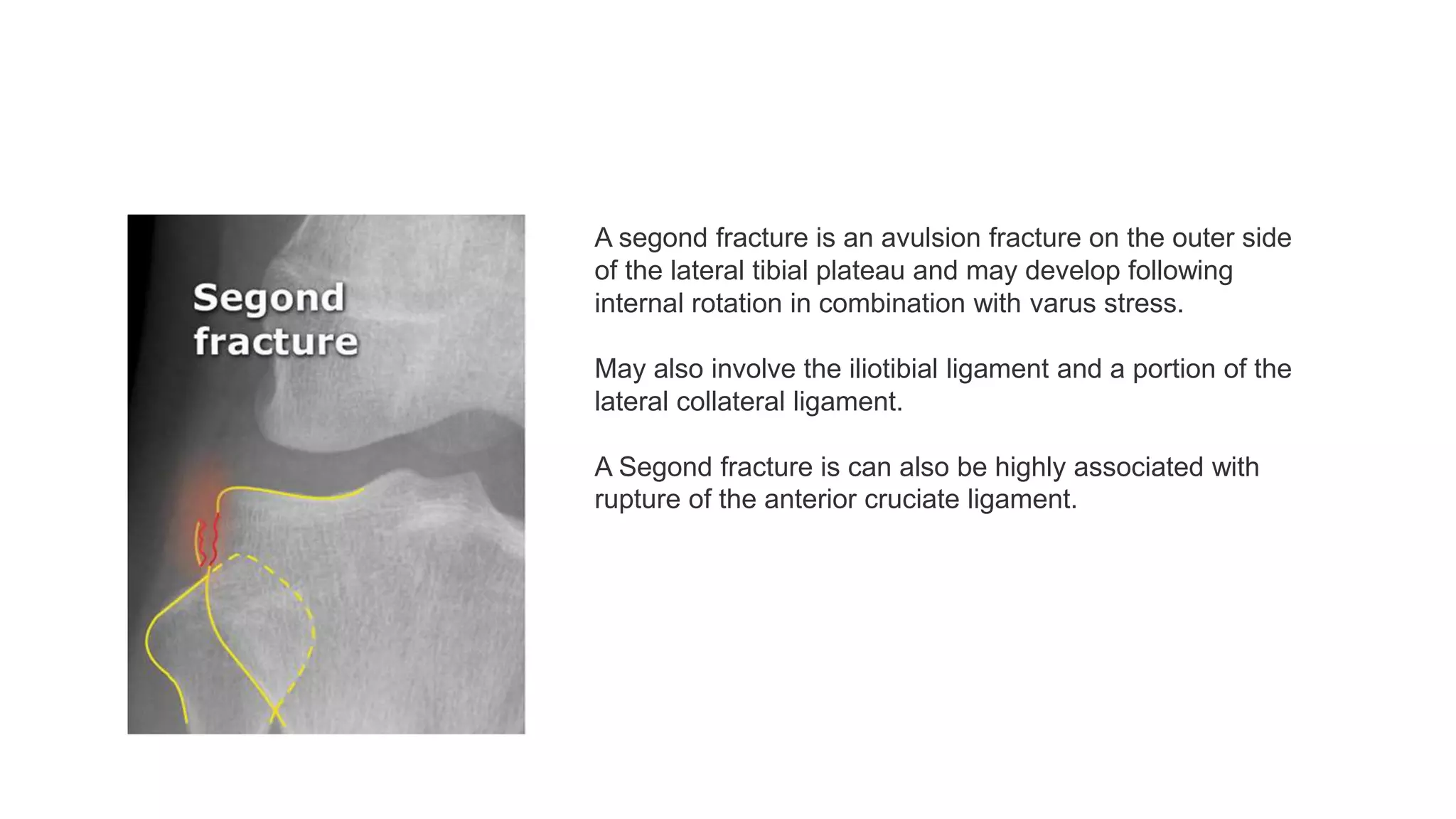 X Ray and MRI of Knee Joint | PPTX