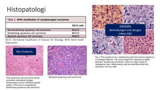 KARSINOMA NASOFARING SERTA TATALAKSANANYA | PPTX | Ear, Nose and Throat ...