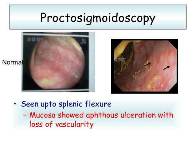 Approach to chronic diarrhea - Dr. Vishnu Biradar