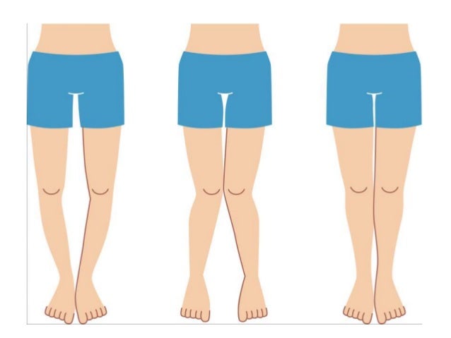Knock Knees Images Knock Knees Straighten Bow Legs Cause Of Bow Le