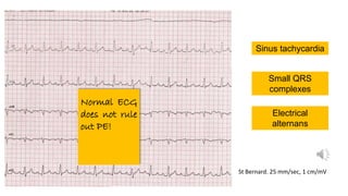 How to treat pericardial effusion | PPTX