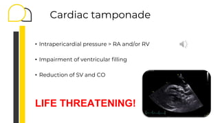 How to treat pericardial effusion | PPT