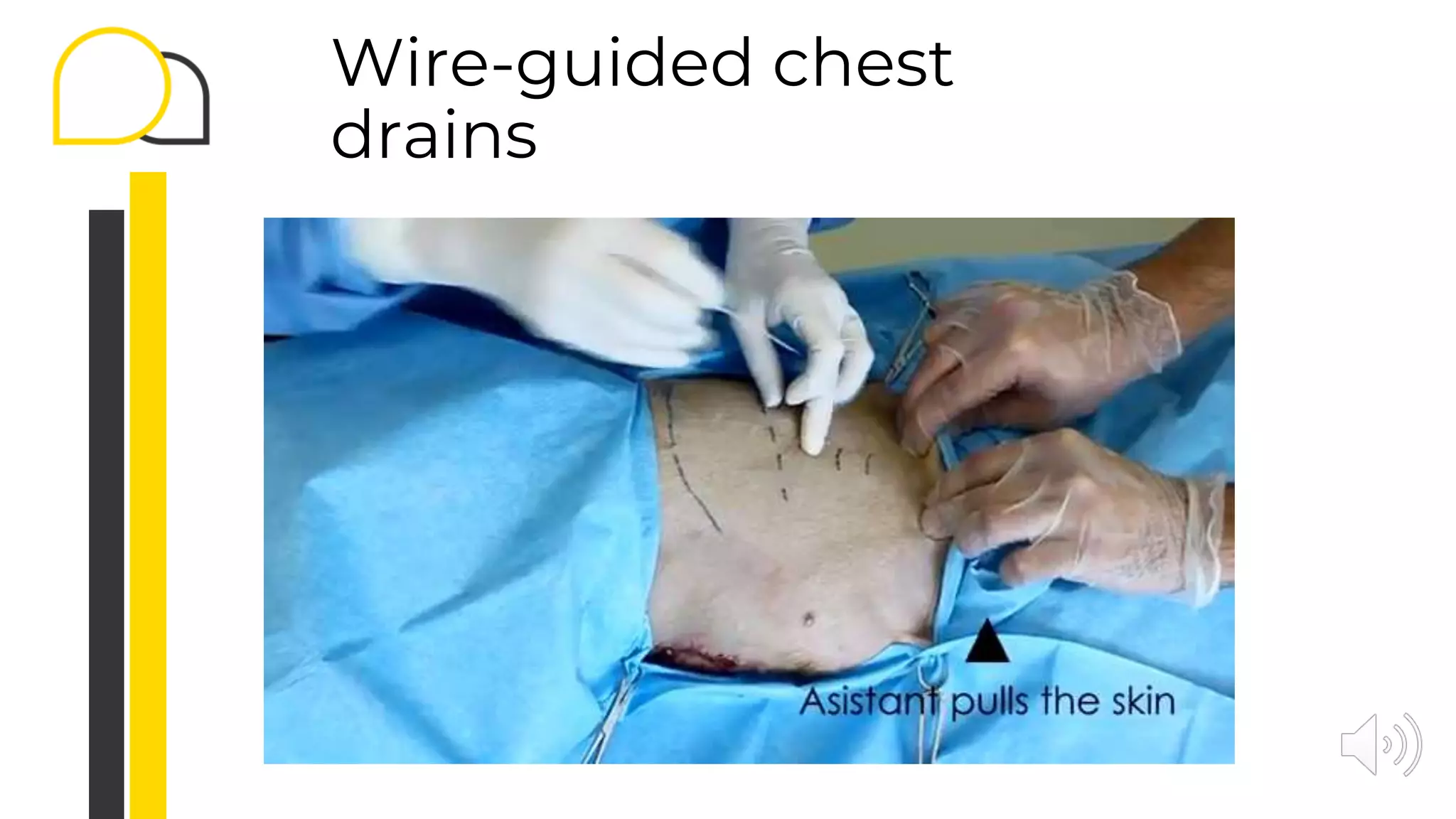Know how to thoracocentesis and thoracostomy tubes | PPTX