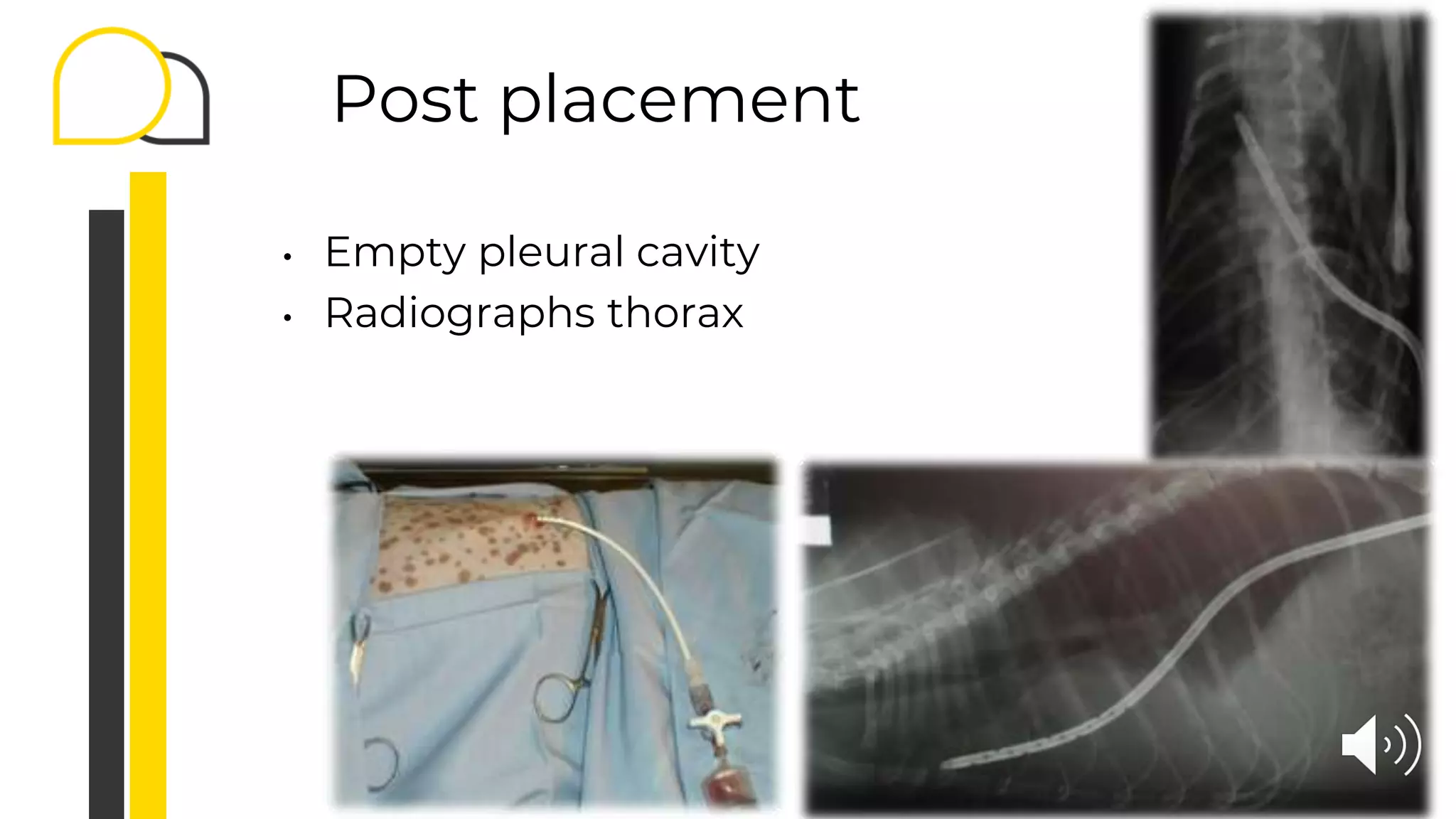 Know how to thoracocentesis and thoracostomy tubes | PPTX