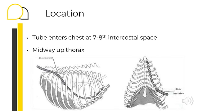 Know how to thoracocentesis and thoracostomy tubes | PPTX