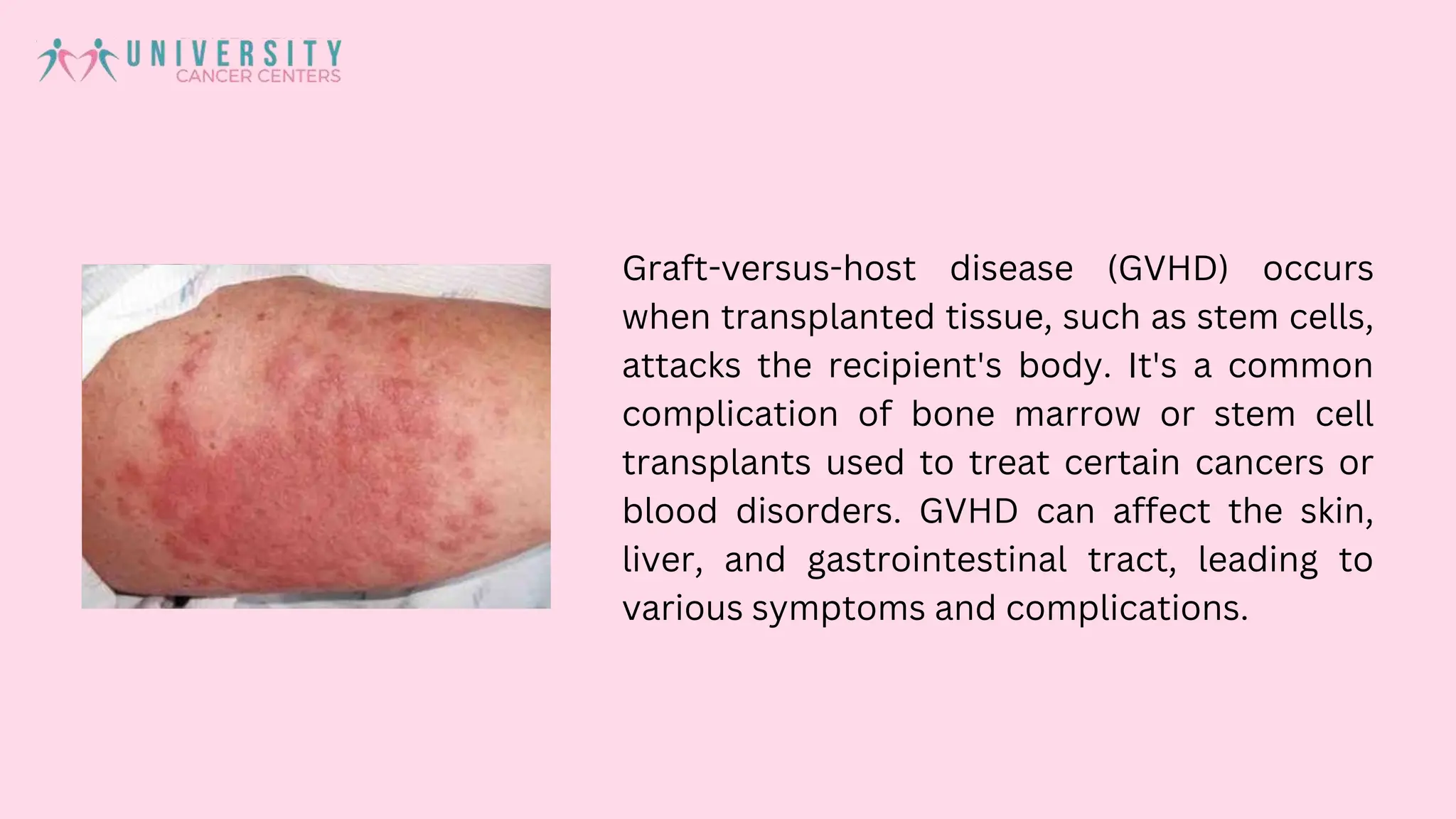 Know About GRAFT VS HOST DISEASE CAUSES, DIAGNOSIS, TREATMENT, AND MORE.ppt