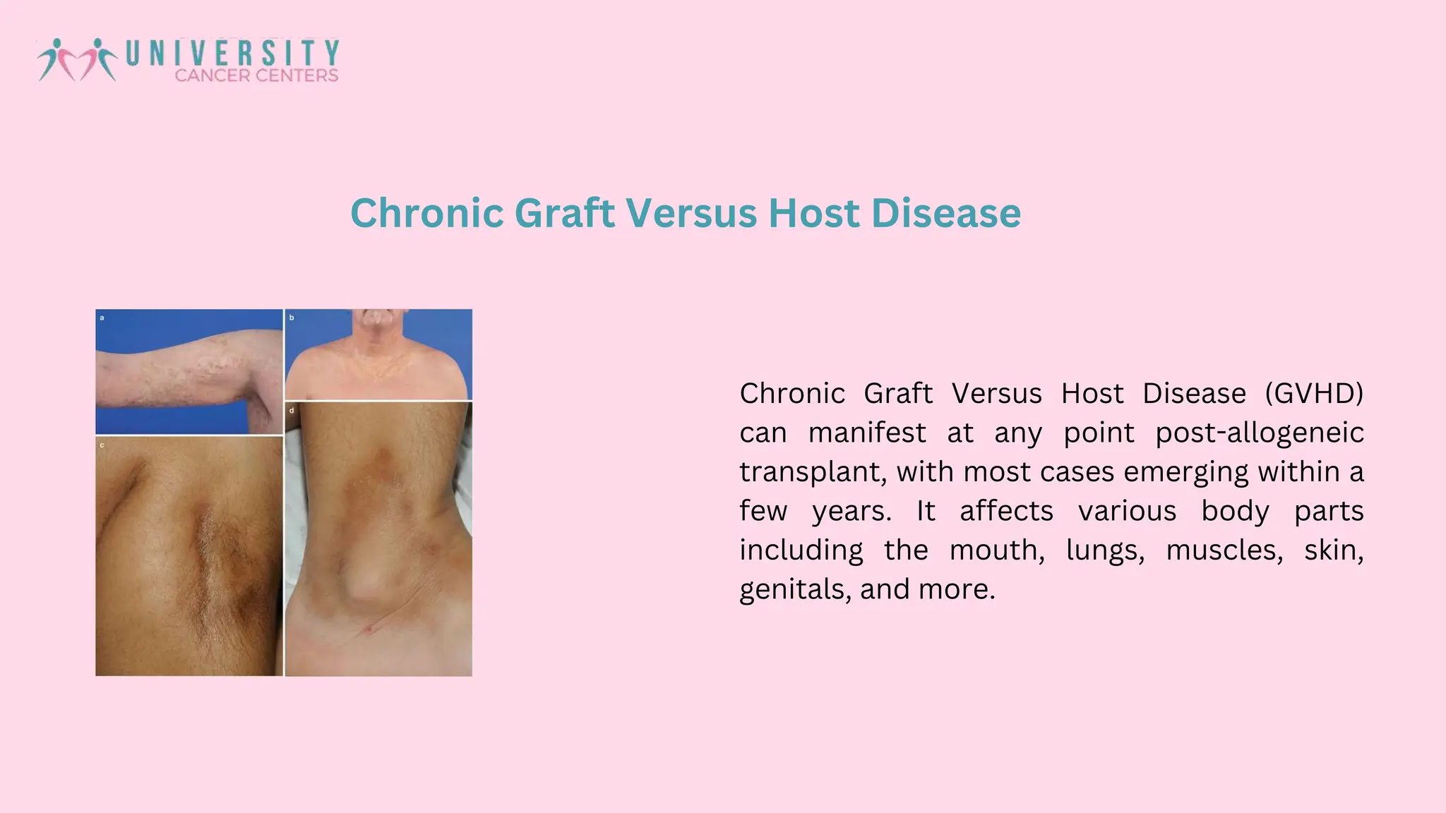 Know About GRAFT VS HOST DISEASE CAUSES, DIAGNOSIS, TREATMENT, AND MORE.ppt