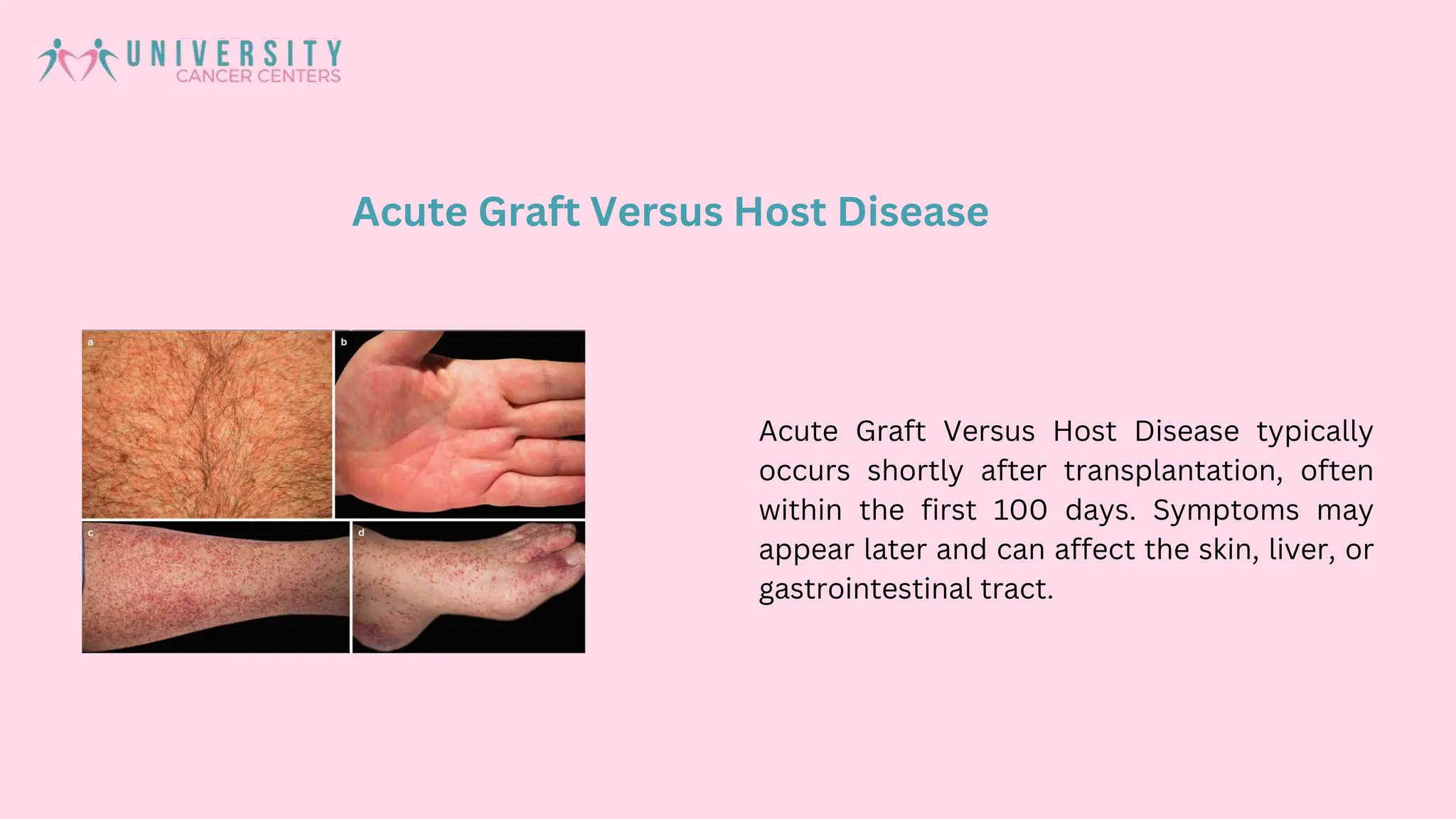 Know About Graft Vs Host Disease Causes Diagnosis Treatment And Moreppt