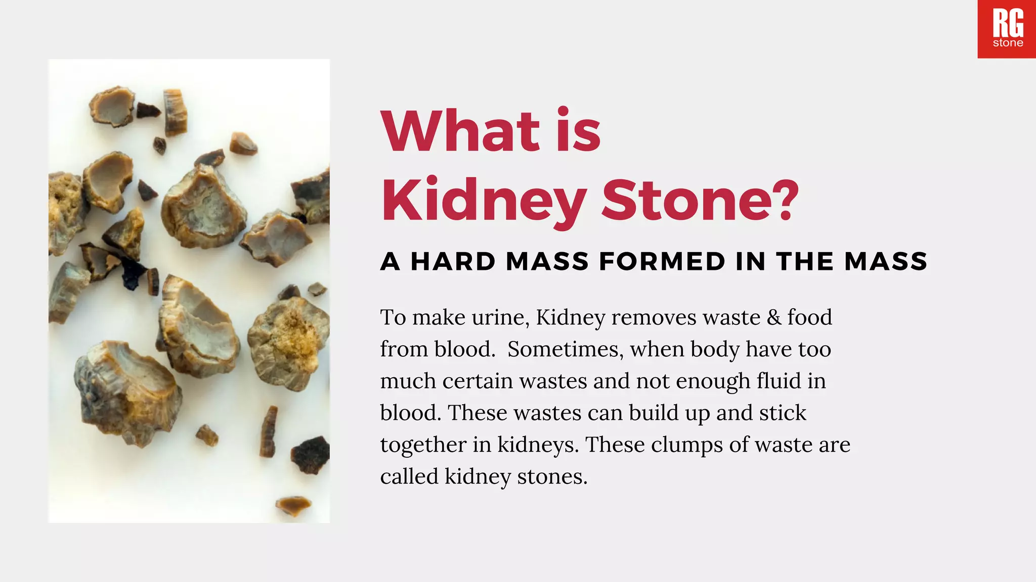 All You Need to Know About kidney Stone - by RG Stone Hospital | PDF