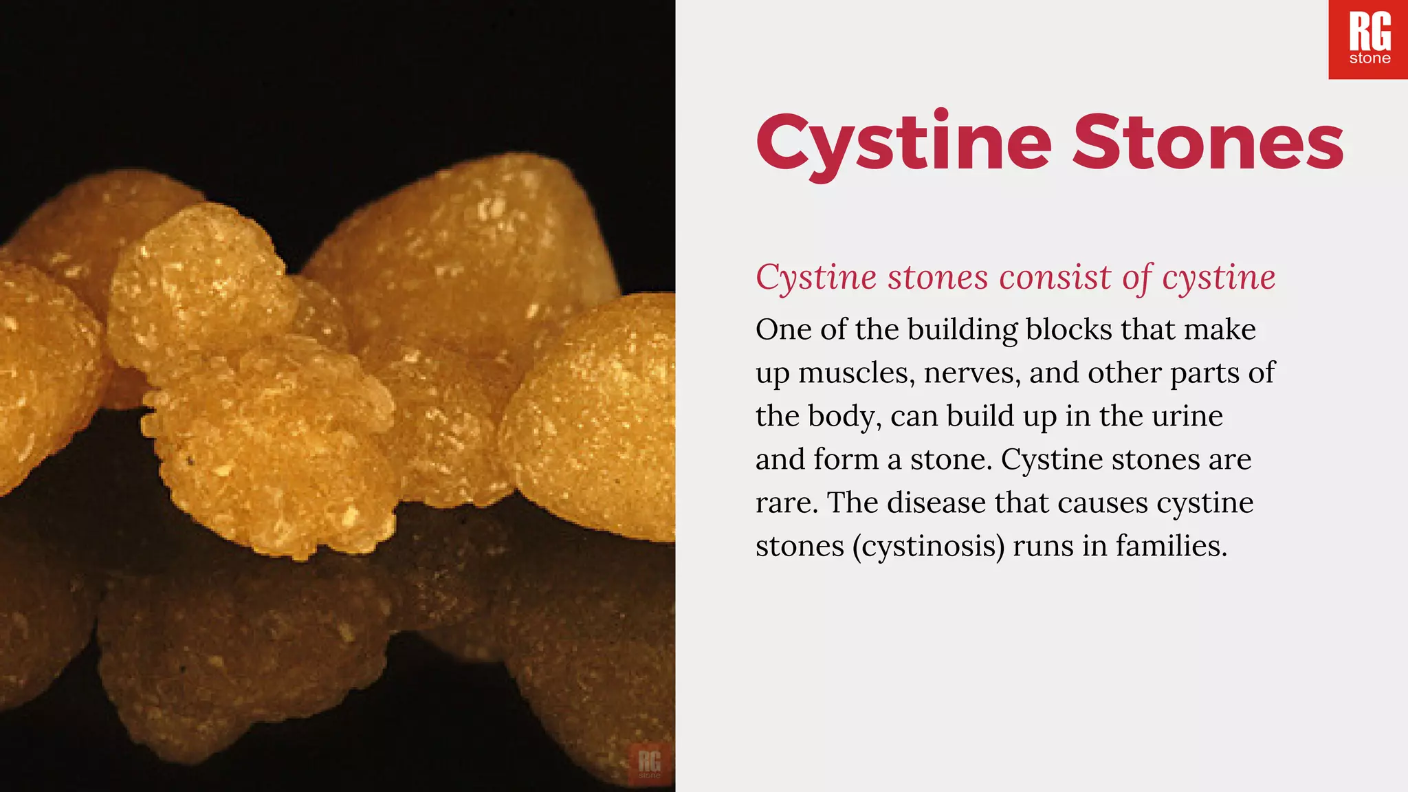 All You Need to Know About kidney Stone - by RG Stone Hospital | PDF