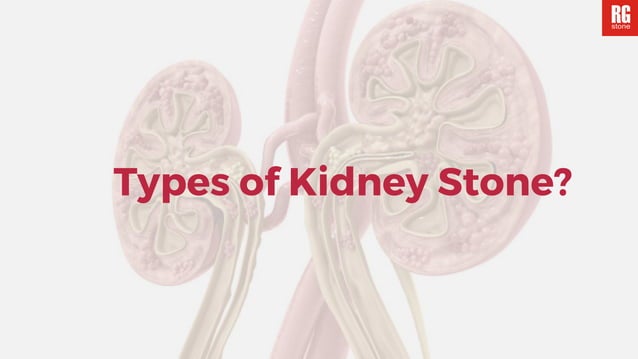 All You Need to Know About kidney Stone - by RG Stone Hospital | PDF ...