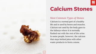 All You Need to Know About kidney Stone - by RG Stone Hospital | PDF