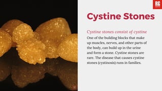 All You Need to Know About kidney Stone - by RG Stone Hospital | PDF