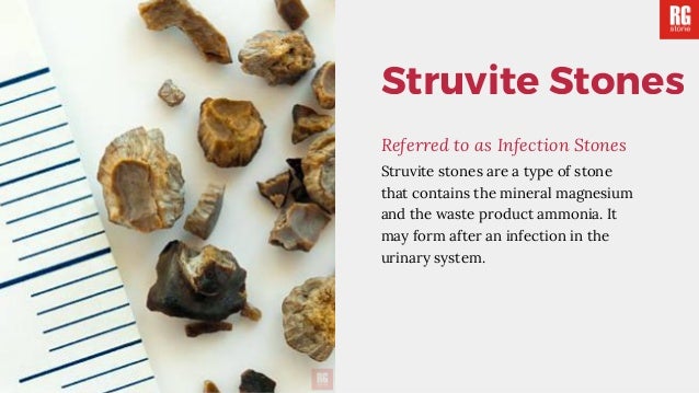 All You Need to Know About kidney Stone - by RG Stone Hospital