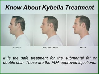 Details About Kybella Treatment | PPT