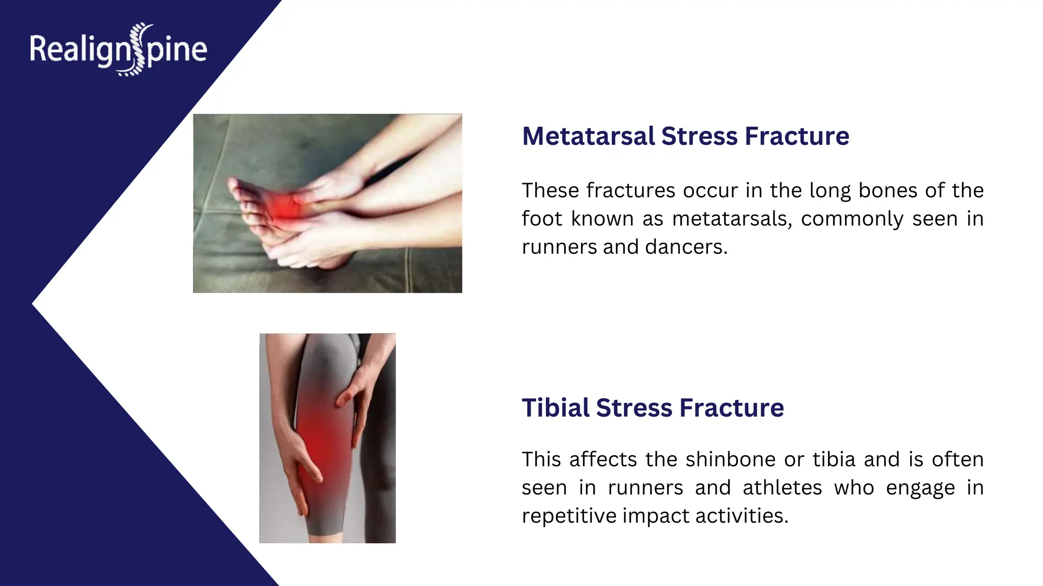 Know About Stress Fracture - Realign Spine | PPT