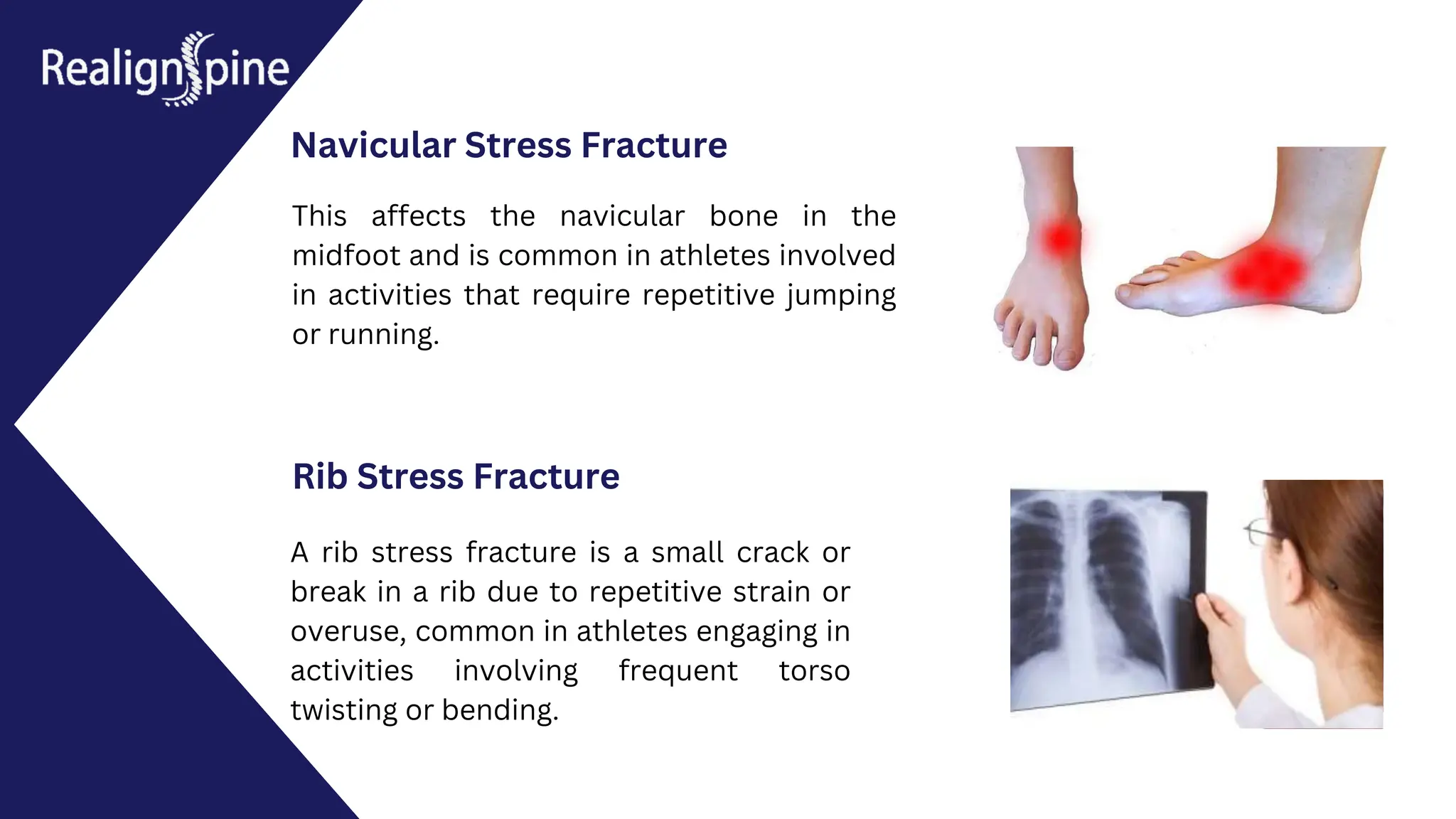 Know About Stress Fracture - Realign Spine | PPT