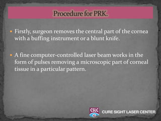 Know everything about prk method eye surgery | PPTX