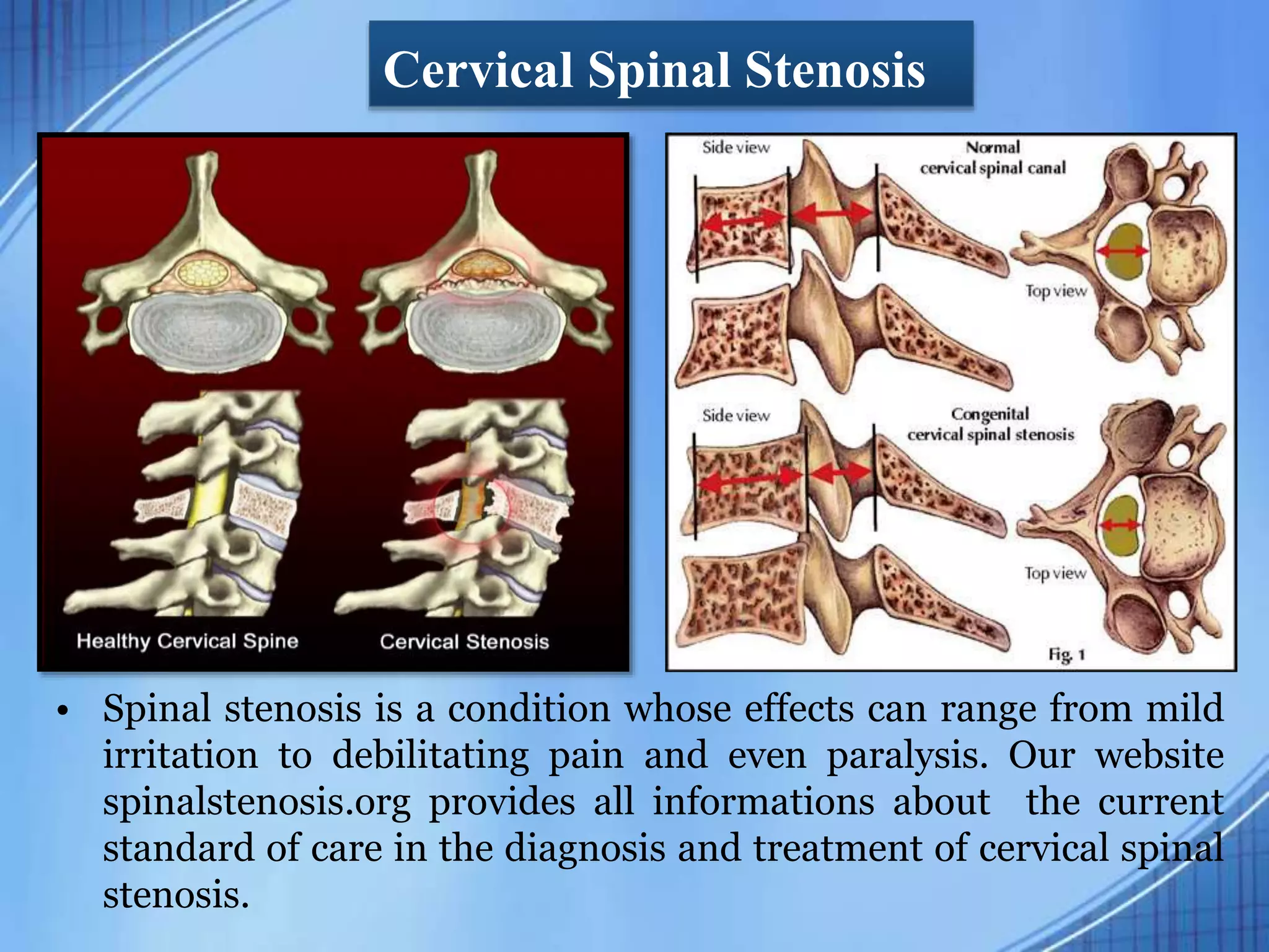 Know in detail about spinal stenosis | PPTX