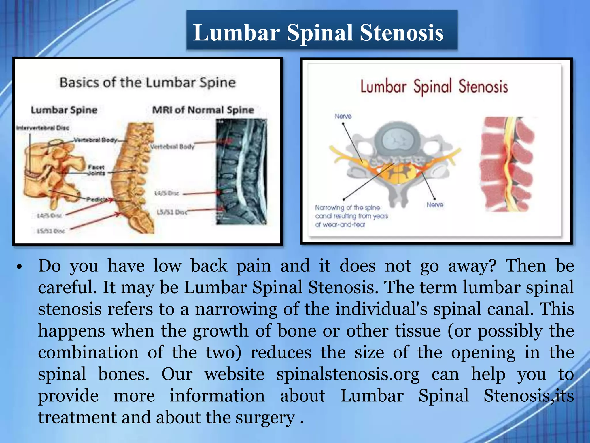 Know in detail about spinal stenosis | PPTX