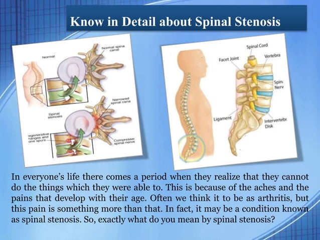 Know in detail about spinal stenosis | PPT