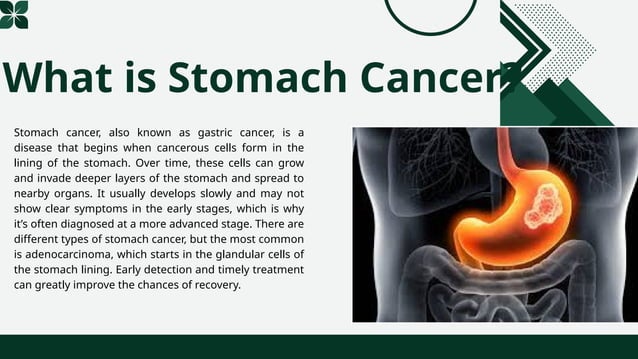 Knowledge about Stomach Cancer.pptx .... | PPTX