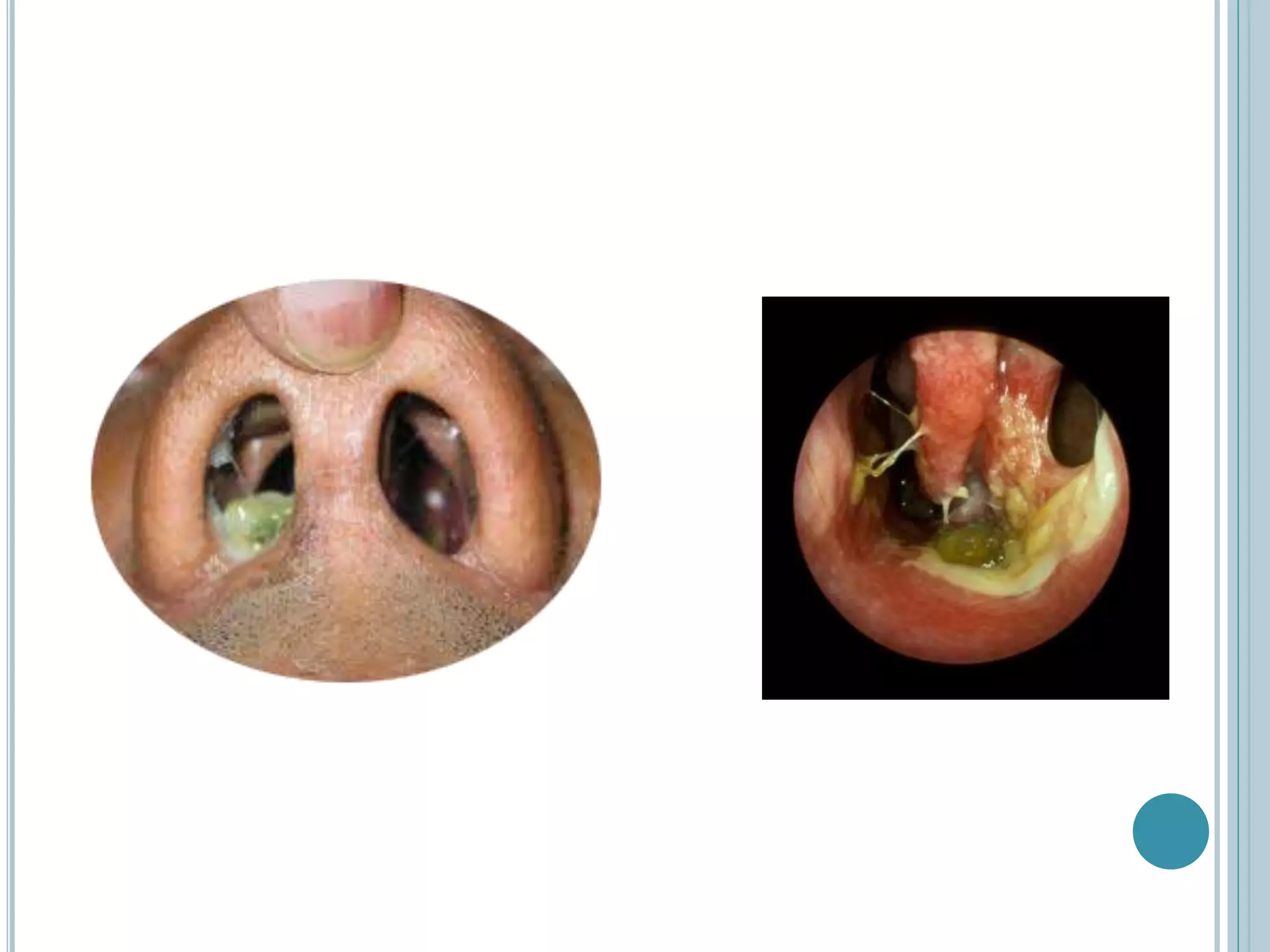atrophic_rhinitis.pptx