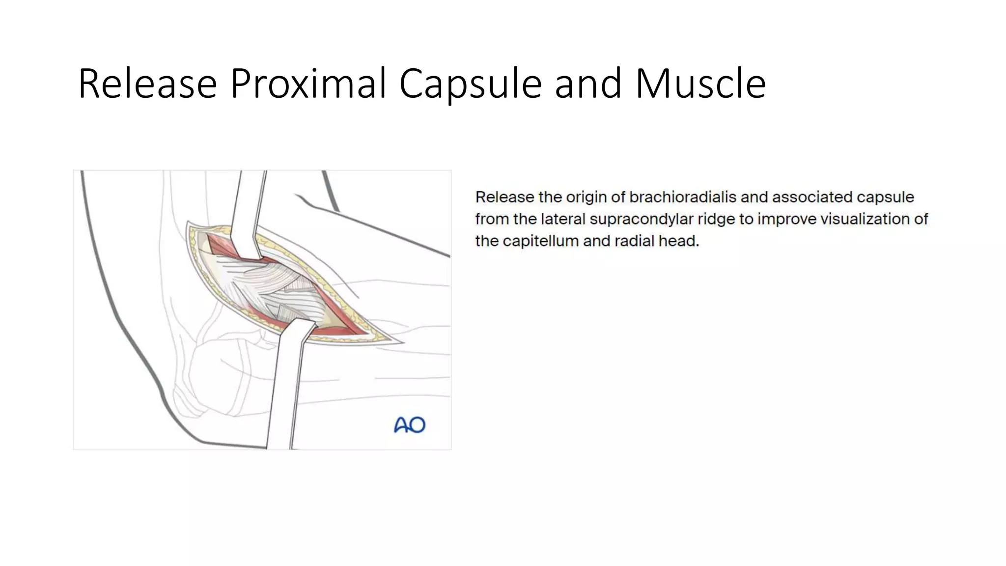 Kocher Approach for Radial Head Fracture.pptx