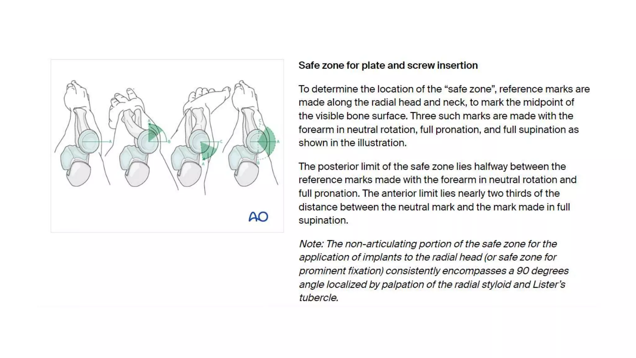 Kocher Approach for Radial Head Fracture.pptx