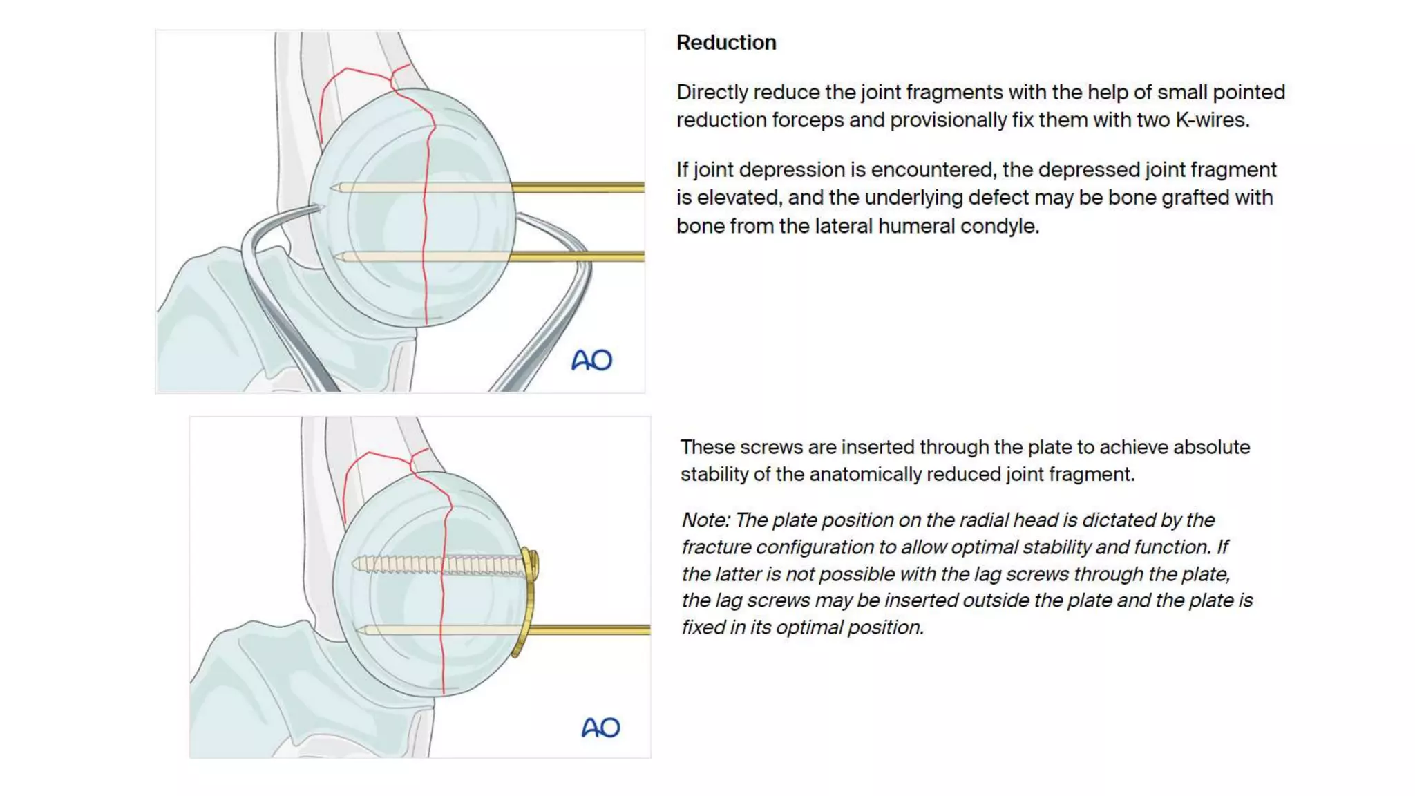 Kocher Approach for Radial Head Fracture.pptx