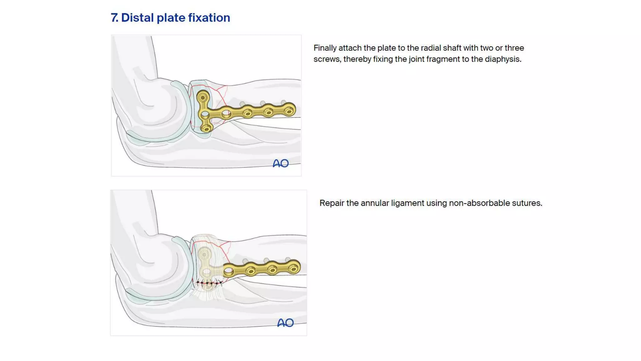 Kocher Approach for Radial Head Fracture.pptx