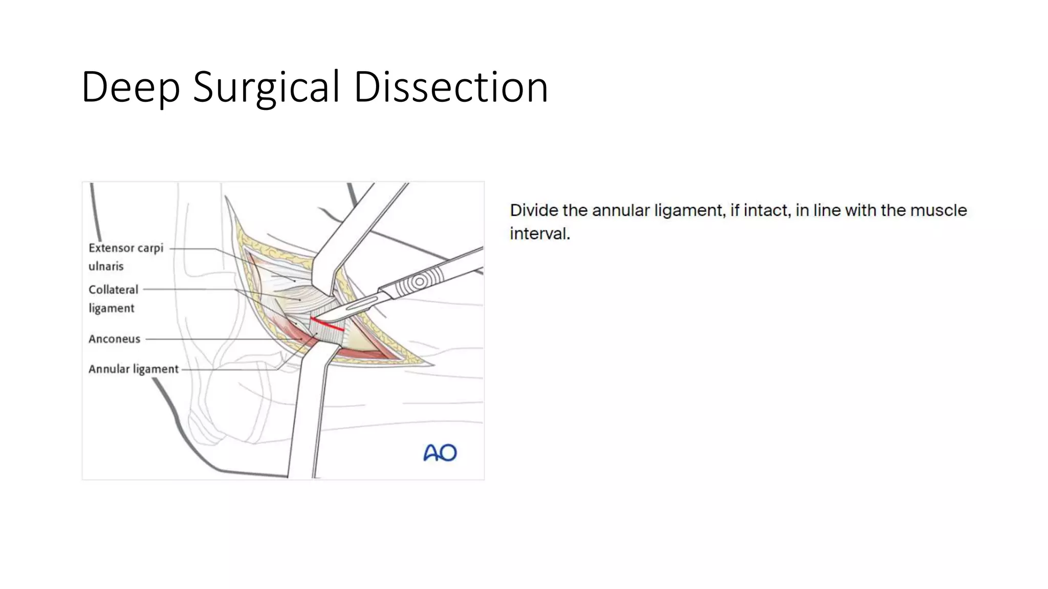Kocher Approach for Radial Head Fracture.pptx