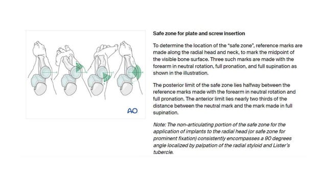 Kocher Approach for Radial Head Fracture.pptx