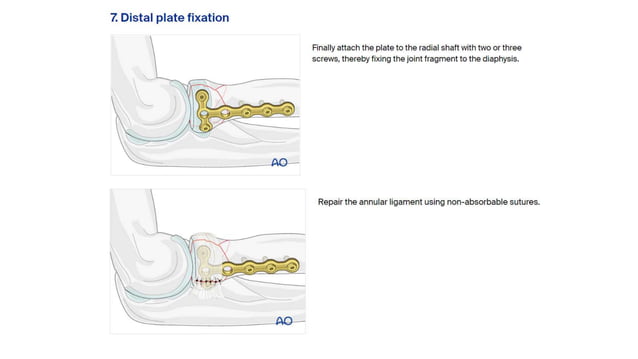 Kocher Approach for Radial Head Fracture.pptx