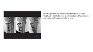 Kocher Approach for Radial Head Fracture.pptx