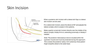 Kocher Approach for Radial Head Fracture.pptx