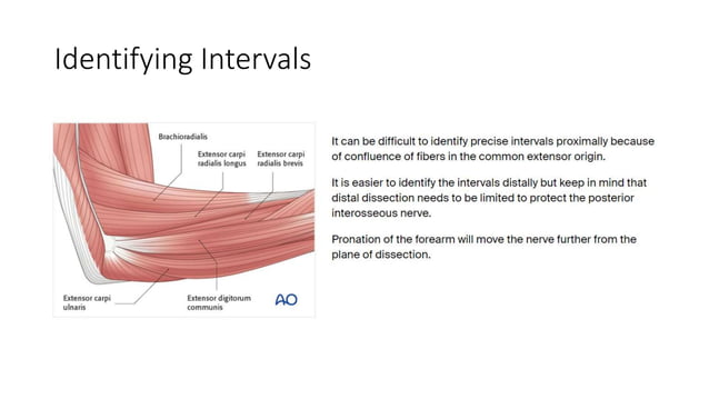 Kocher Approach for Radial Head Fracture.pptx