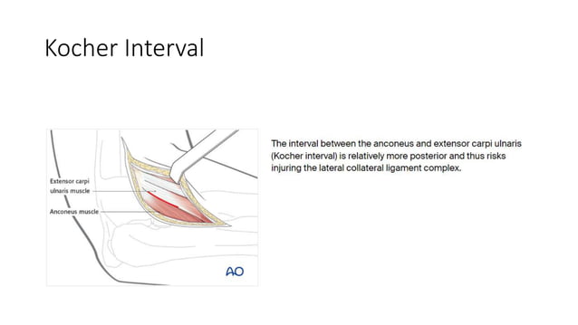 Kocher Approach for Radial Head Fracture.pptx
