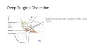Kocher Approach for Radial Head Fracture.pptx