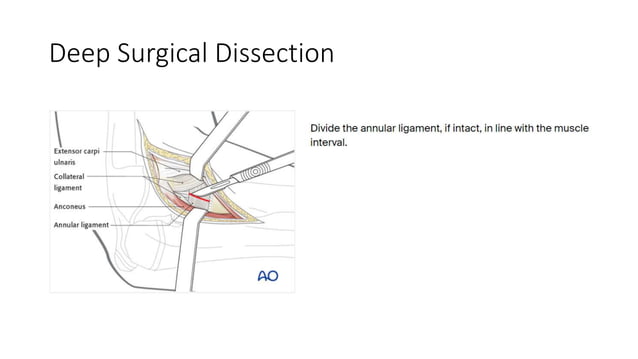 Kocher Approach for Radial Head Fracture.pptx