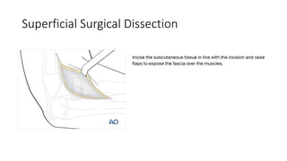 Kocher Approach for Radial Head Fracture.pptx