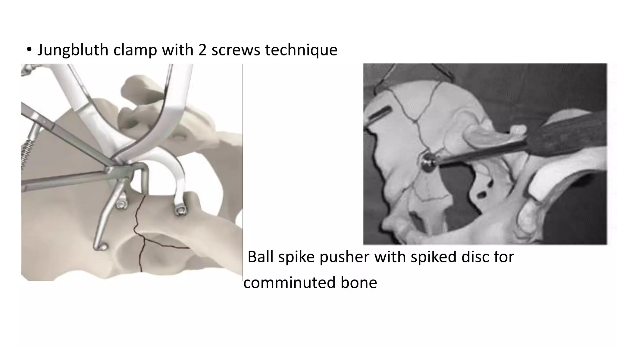 Kocher-Langenbeck acetabular approach | PPTX