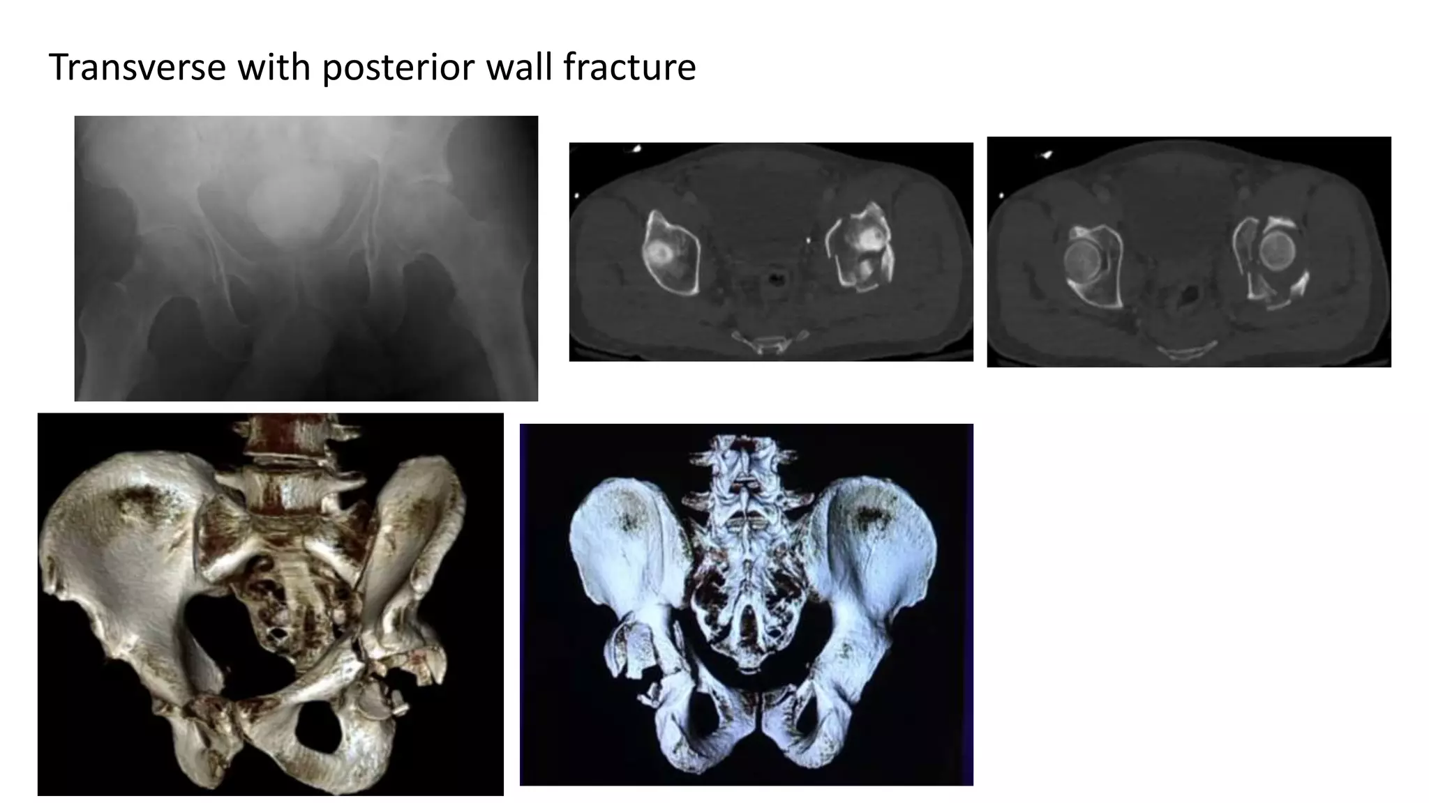 Kocher-Langenbeck acetabular approach | PPTX