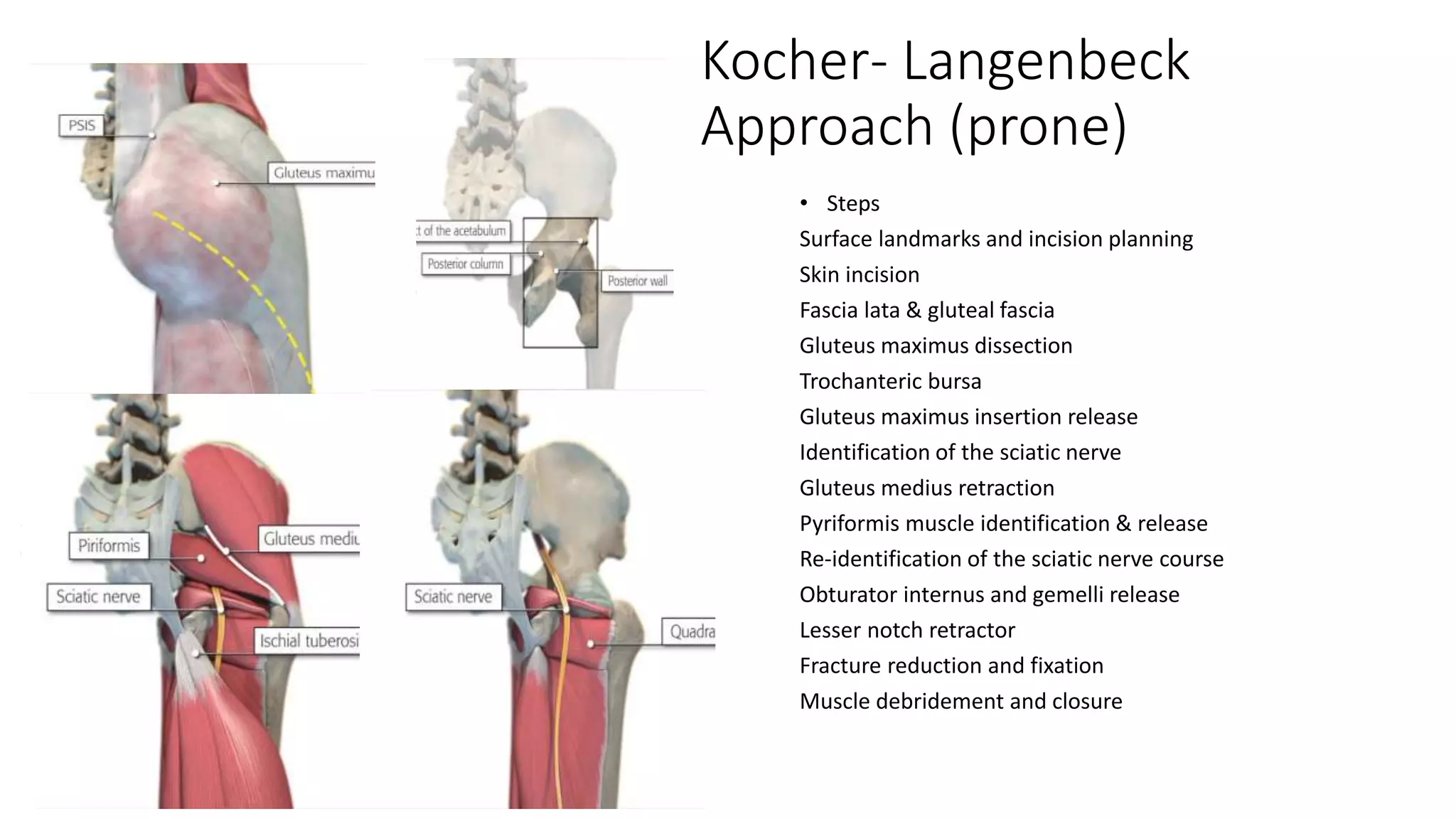 Kocher-Langenbeck acetabular approach | PPTX