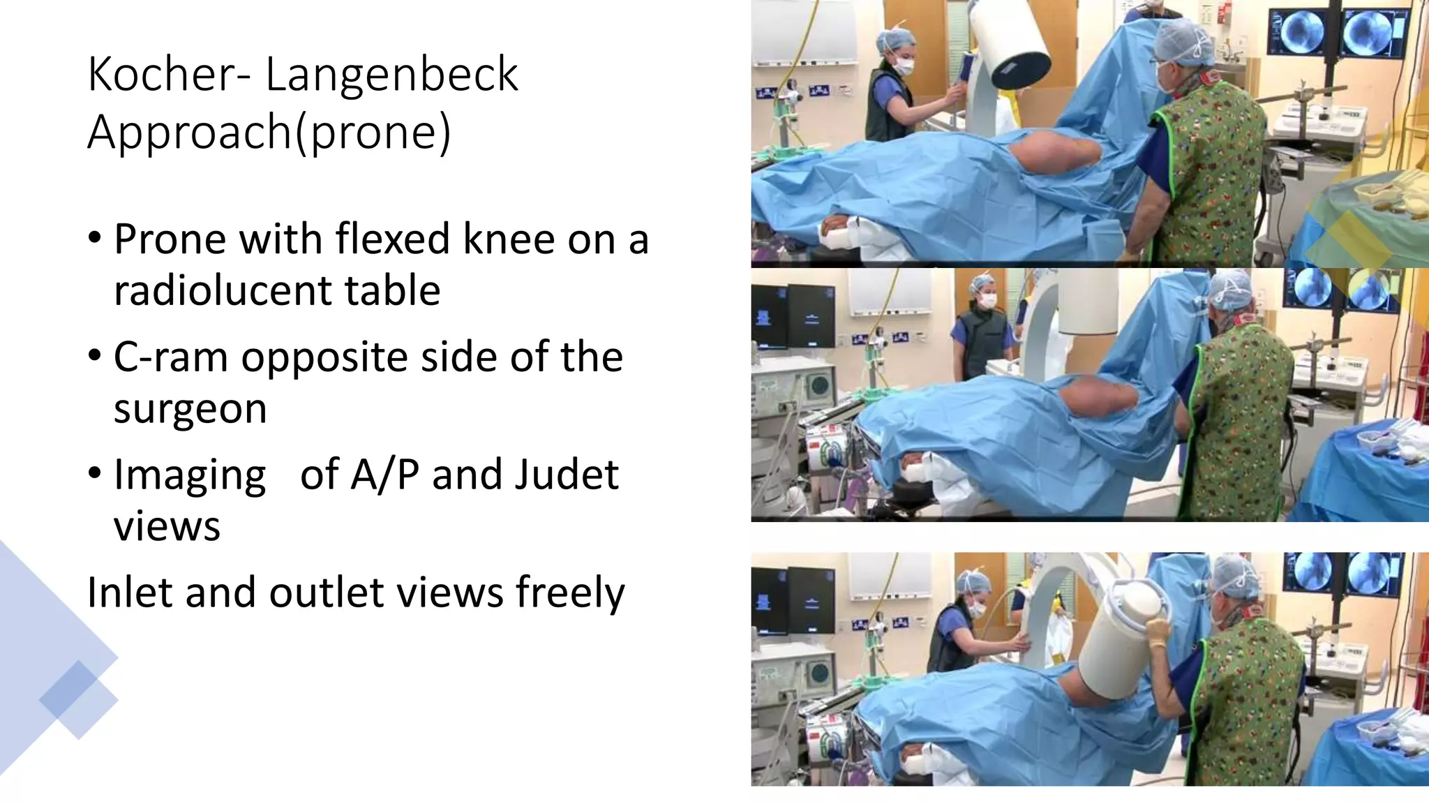 Kocher-Langenbeck acetabular approach | PPTX